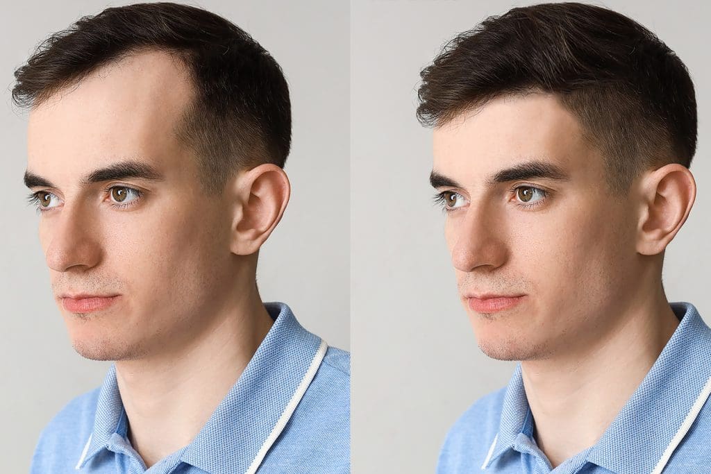 Receding Hairline - Total Hair Restoration | Dublin and Galway